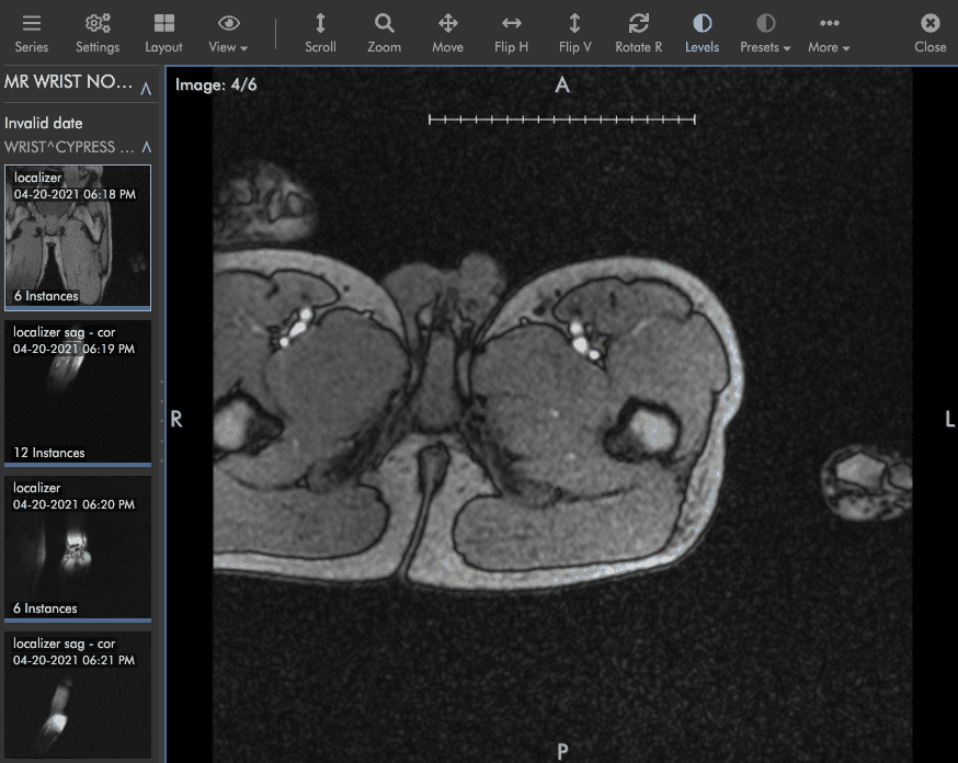 MRI Hand - Mediphany